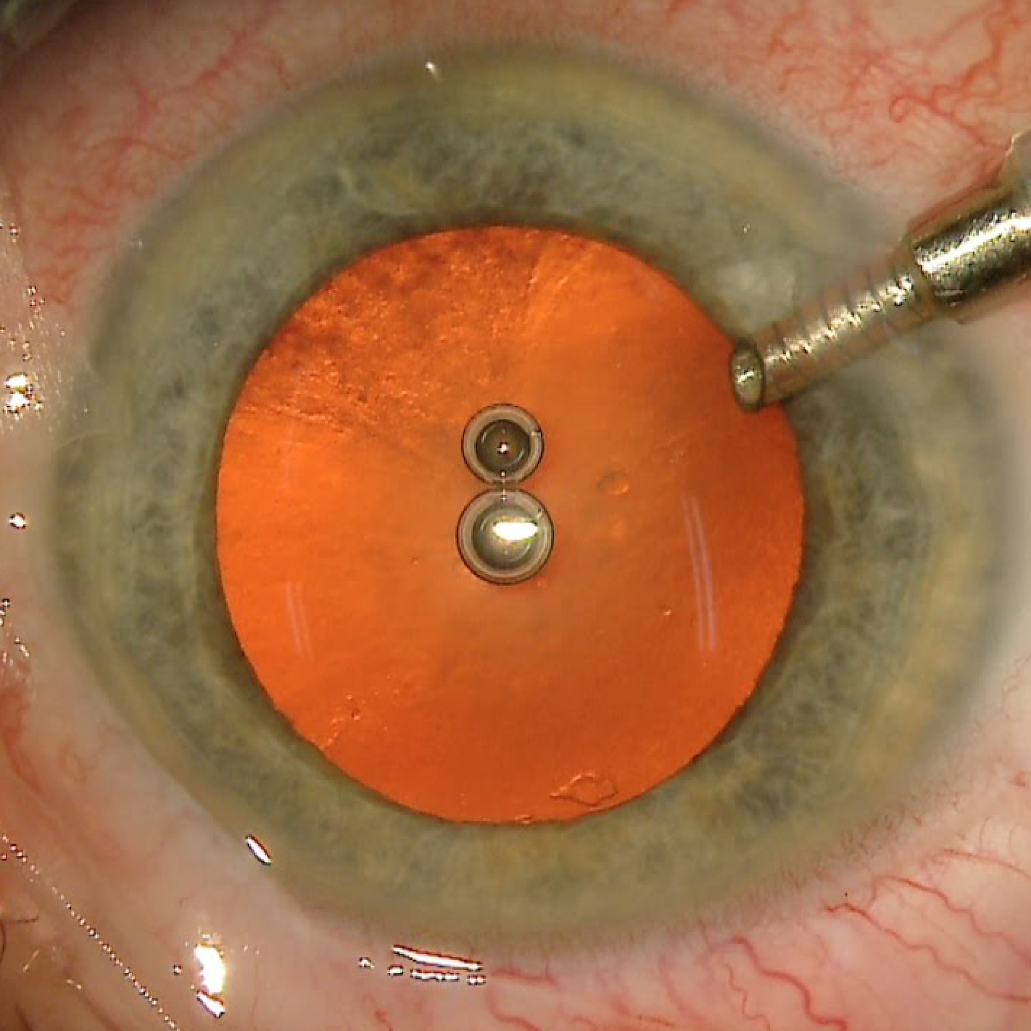 Cirugía de cataratas