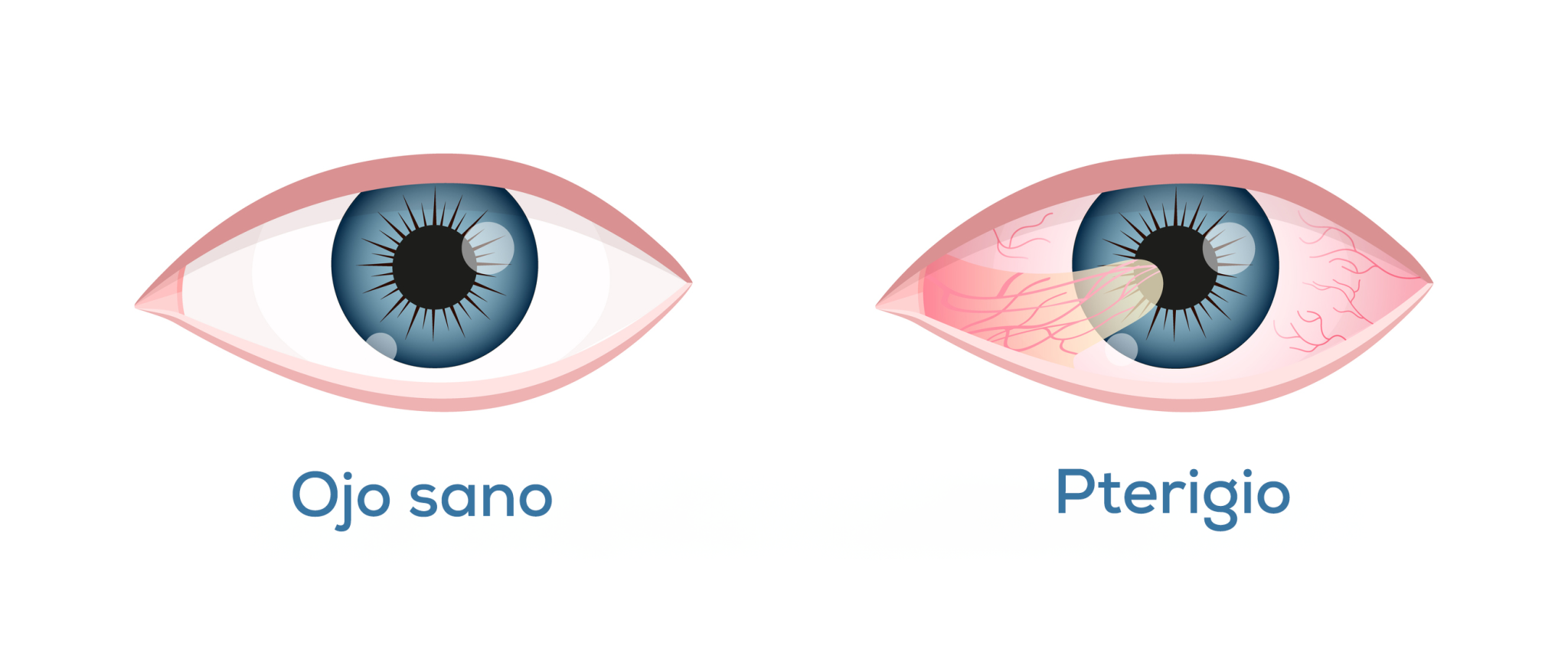 Pterigio: prevención y manejo de la carnosidad en los ojos.